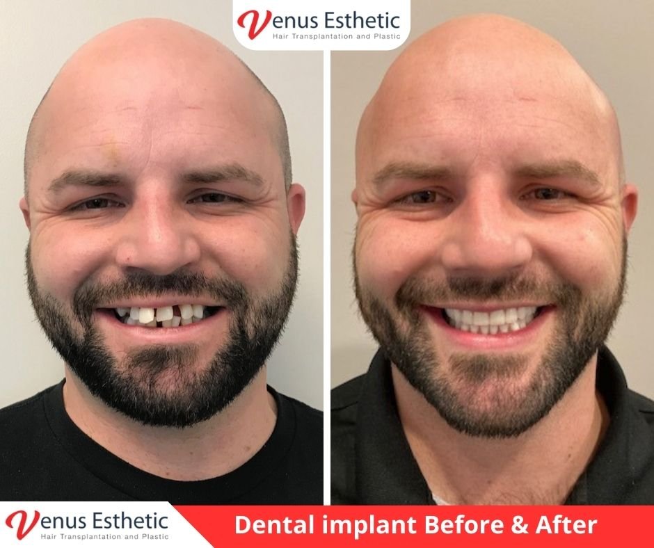 Dental Implant Procedure | Venus Esthetic Clinic