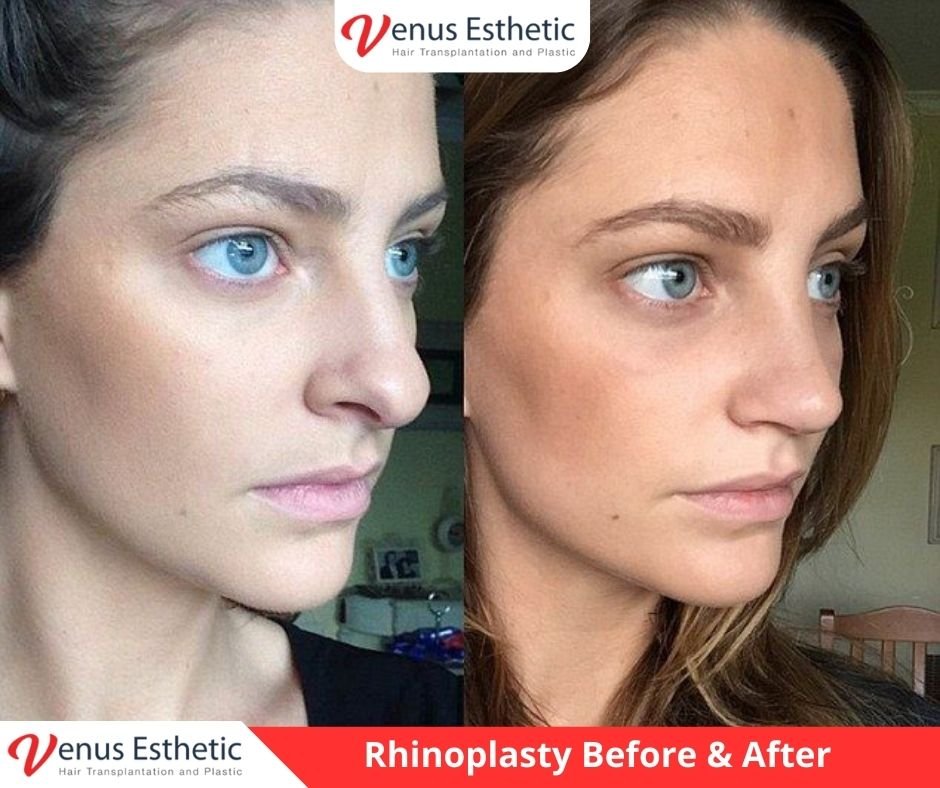 Rhinoplasty in Turkey - Venus Esthetic Clinic