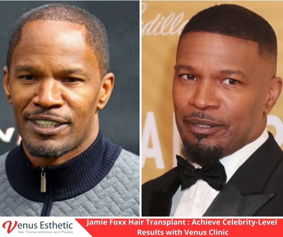 Jamie Foxx Hair Transplant : Achieve Celebrity-Level Results with Venus ...