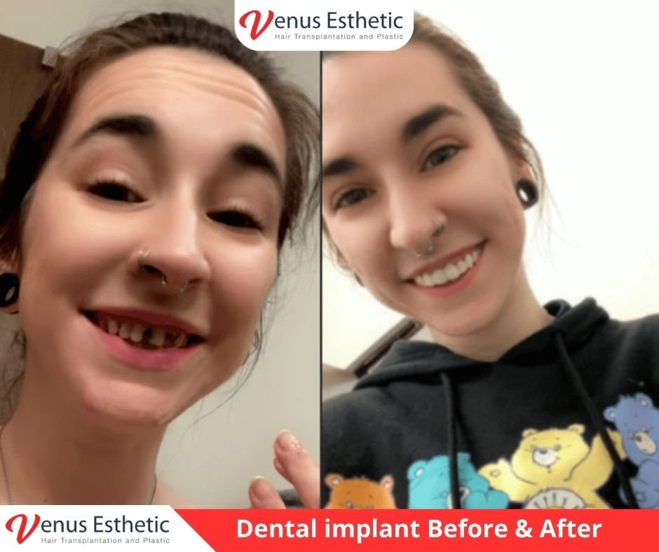 Dental Implant Procedure | Venus Esthetic Clinic