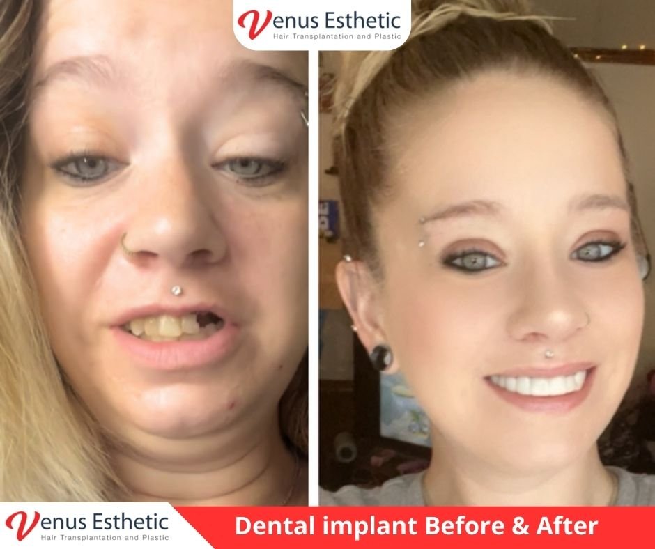 Dental Implant Procedure - Venus Esthetic Clinic